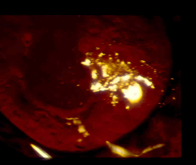 SPRING CATARRH CORNEAL ULCERATION - eyedr4kids