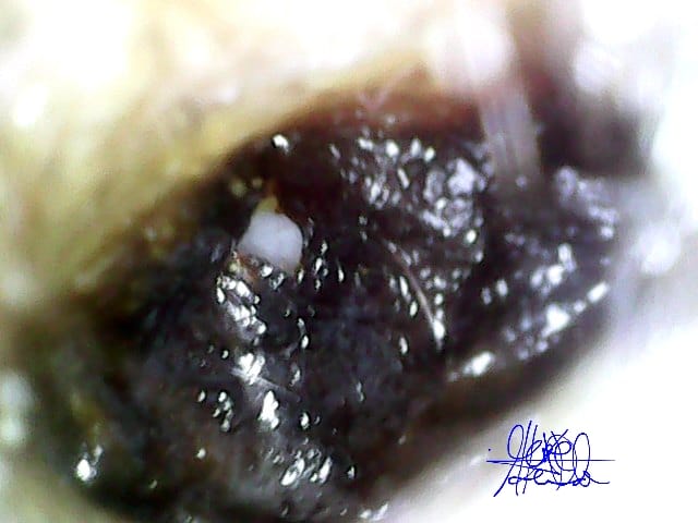 Impacted Ear Wax - Niugini Medical & Diagnostic Services