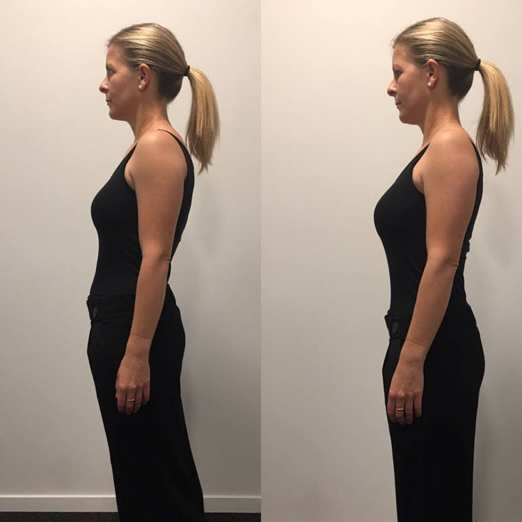 Postural Alignment corrected through the nervous system