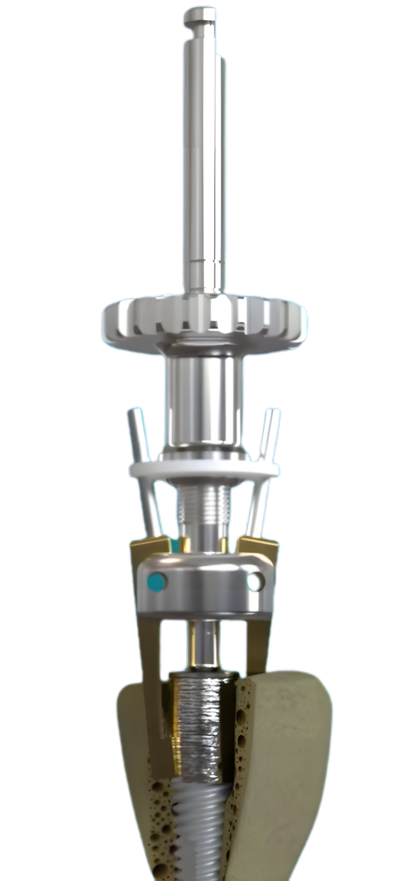 Implantoplasty- provoking or reducing inflammation? – a systematic ...