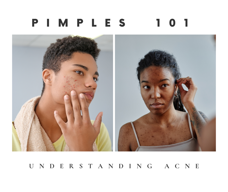 Understanding Acne: Types, Causes, and Myths Debunked