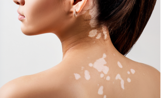 du tatouage sur du vitiligo / vergetures