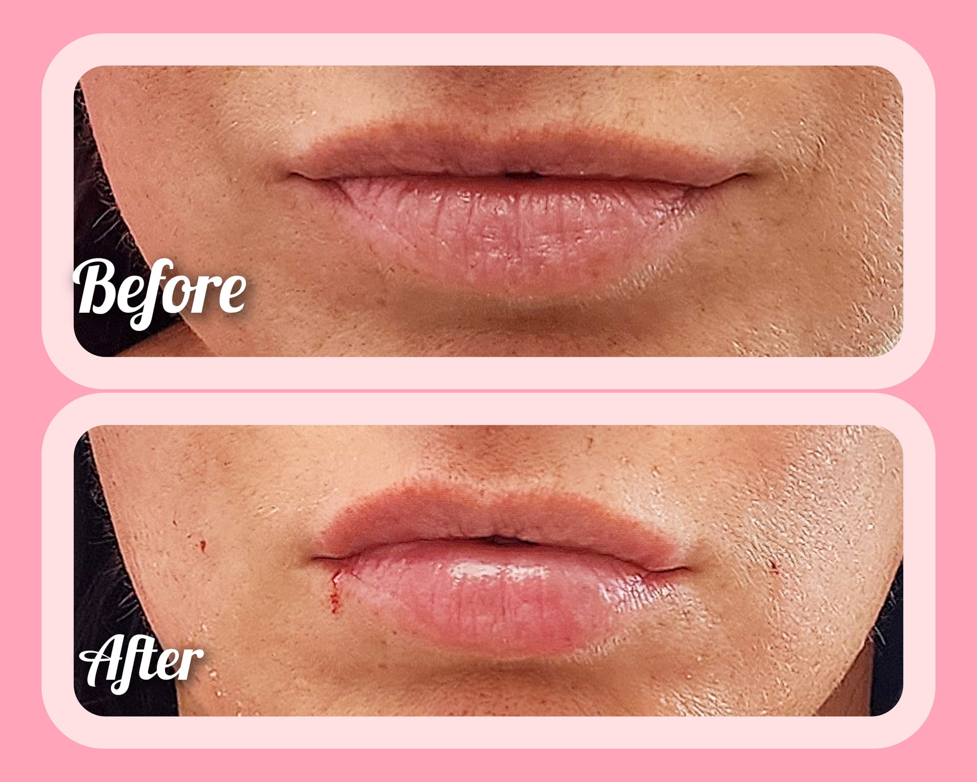 Lip screw threads to borders - Happy Juice Iv and Beauty