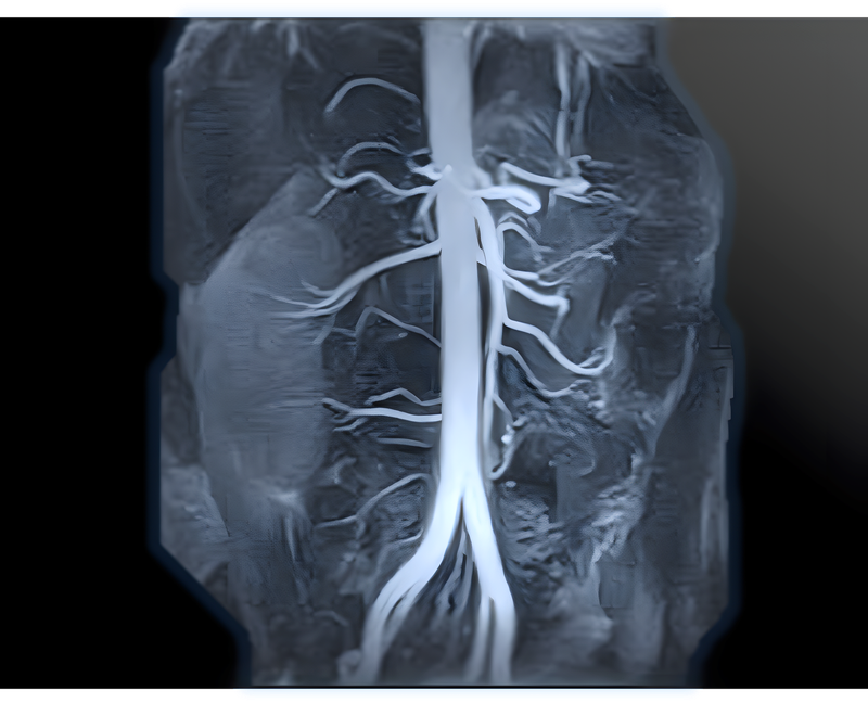 Aortic and Peripheral MR Angiography - Premier Medical Imaging Centers
