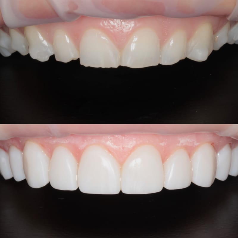 Composite Veneers - Dr James Dentith